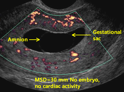 Ultrasound in the First Trimester (All Topics) and Components of Fetal ...